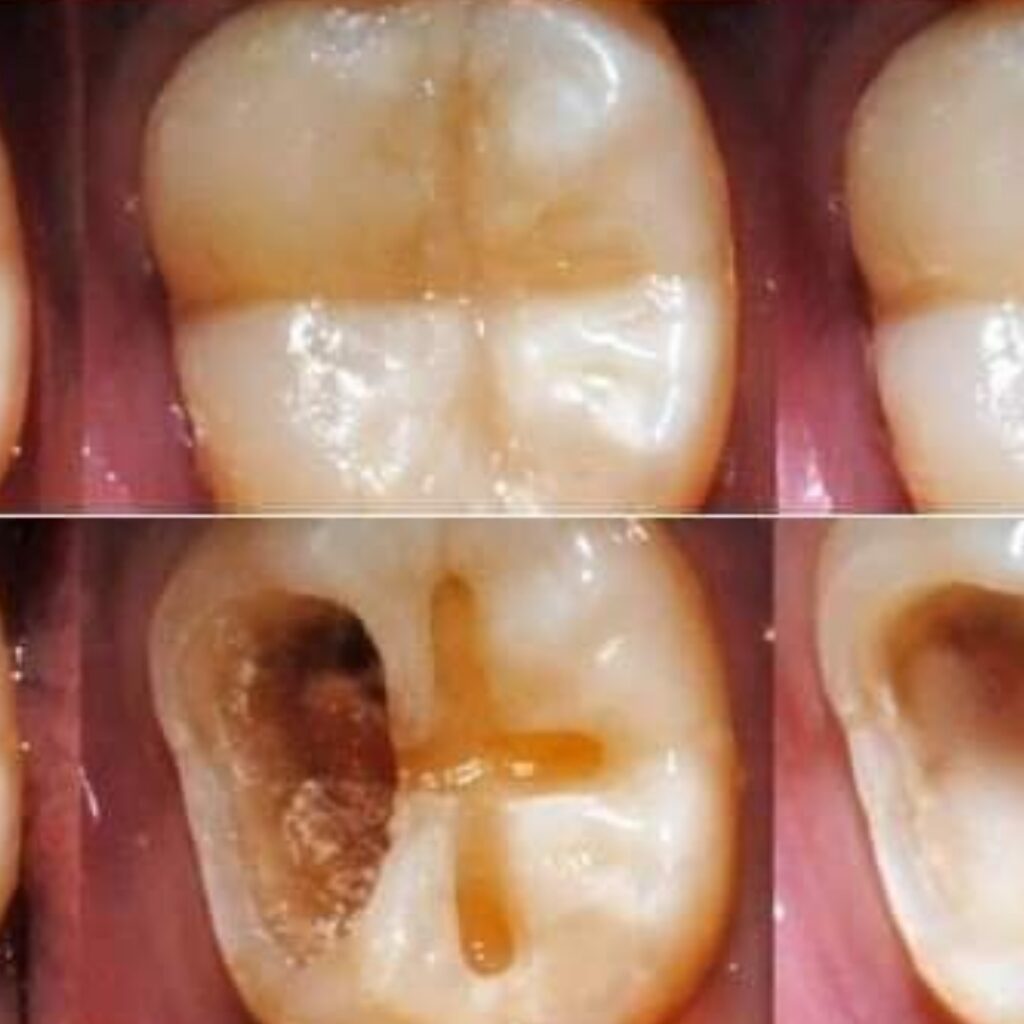 Preventing and Managing Cavities Naturally – FLAVORFUL RECIPES